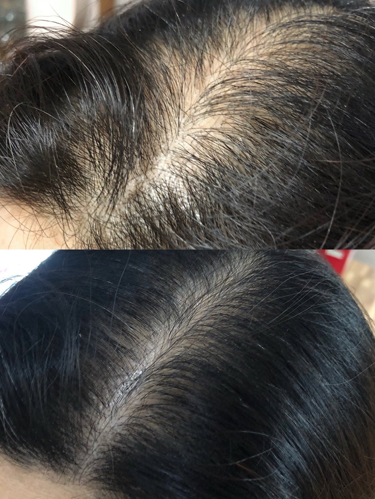 Normal Hair Part vs. Thinning Hair - What's the Difference?